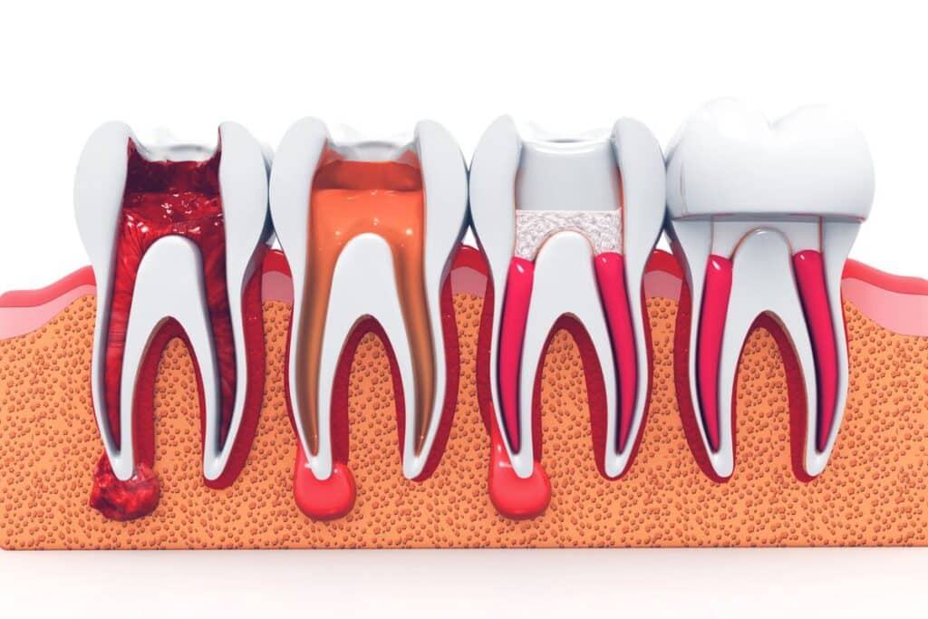 Can a Tooth Fall Out After Root Canal? What You Need to Know