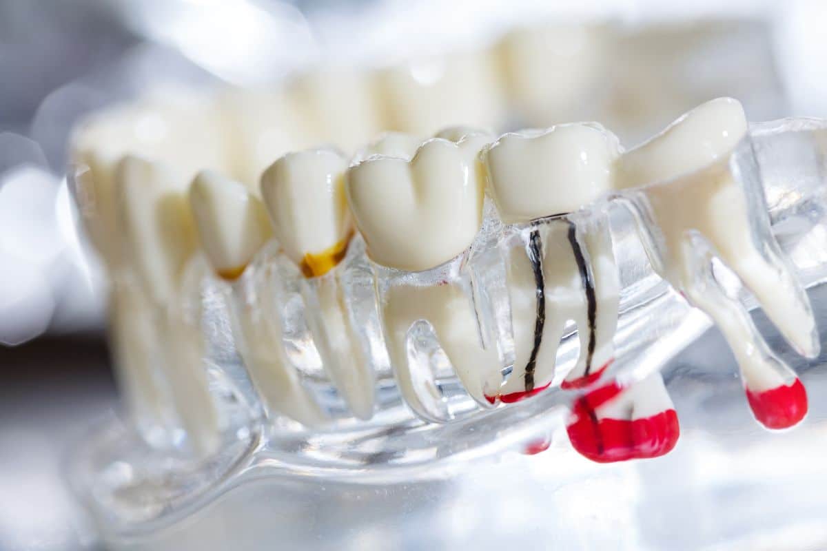 Can a Tooth Fall Out After Root Canal? What You Need to Know